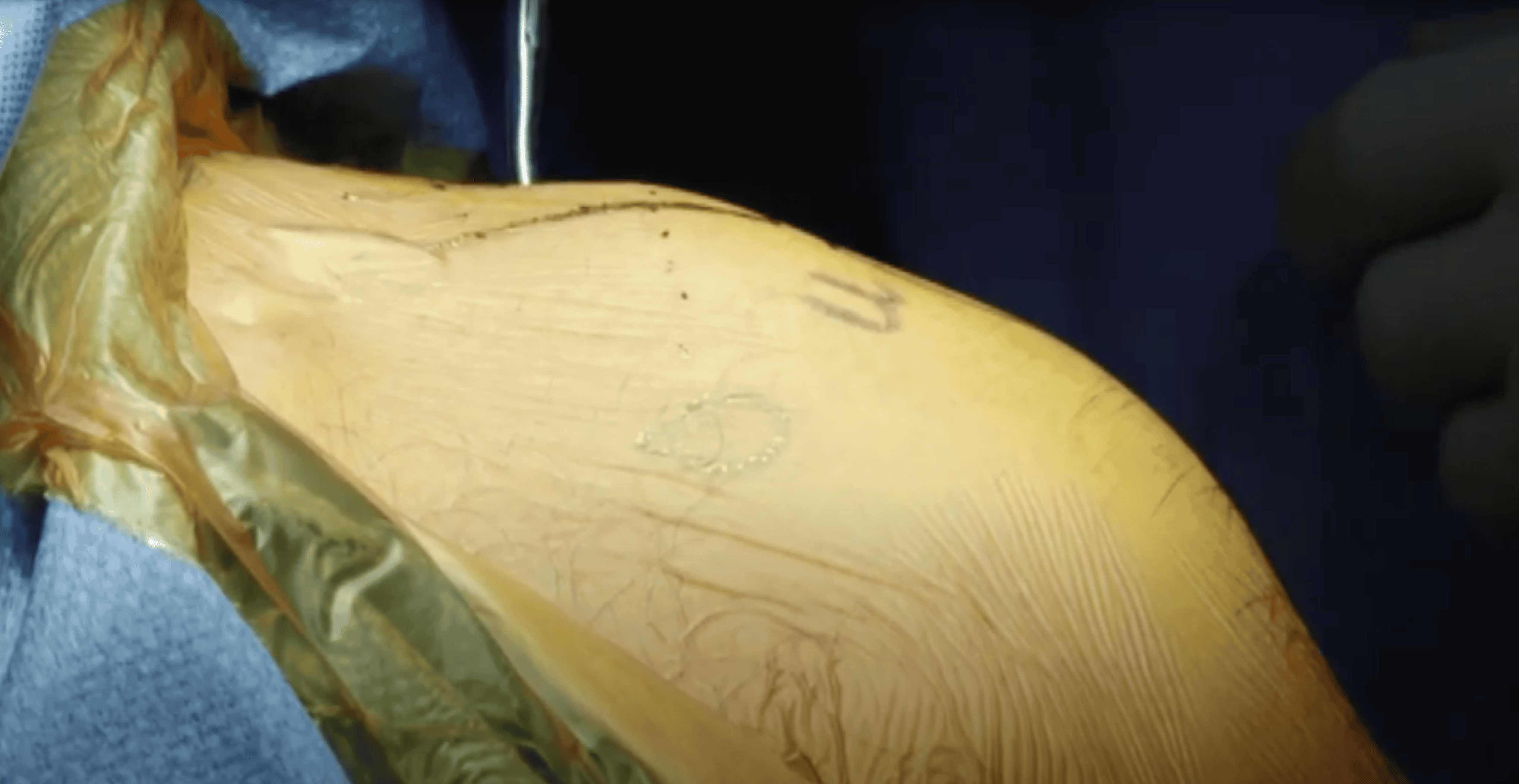 Acromioclavicular Reconstruction with Lockdown Technique - Lockdown Medical