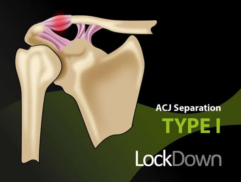AC Joint Separation: Everything You Need to Know - Lockdown Medical