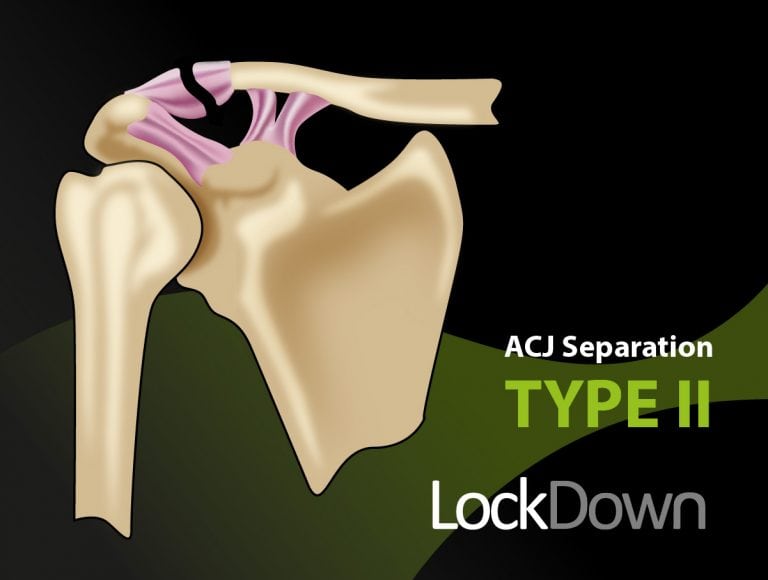 AC Joint Separation: Everything You Need to Know - Lockdown Medical